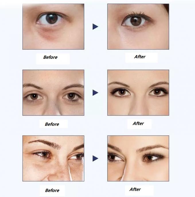 magic eye quantum lifting facial adaoptive smart skin rf radio ...